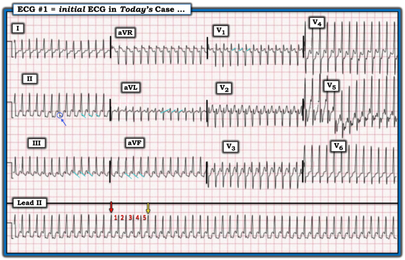 Extremely fast, narrow, regular - Dr. Smith’s ECG Blog