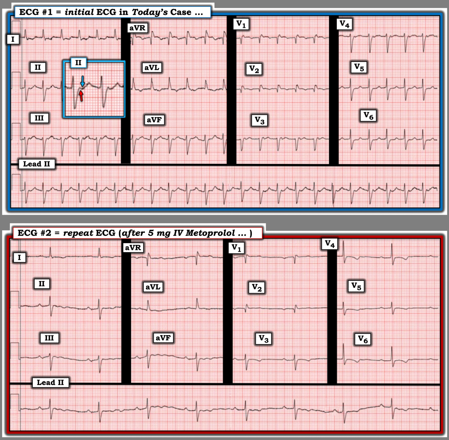 Narrow complex tachycardia, with interesting laddergram - Dr. Smith’s ...