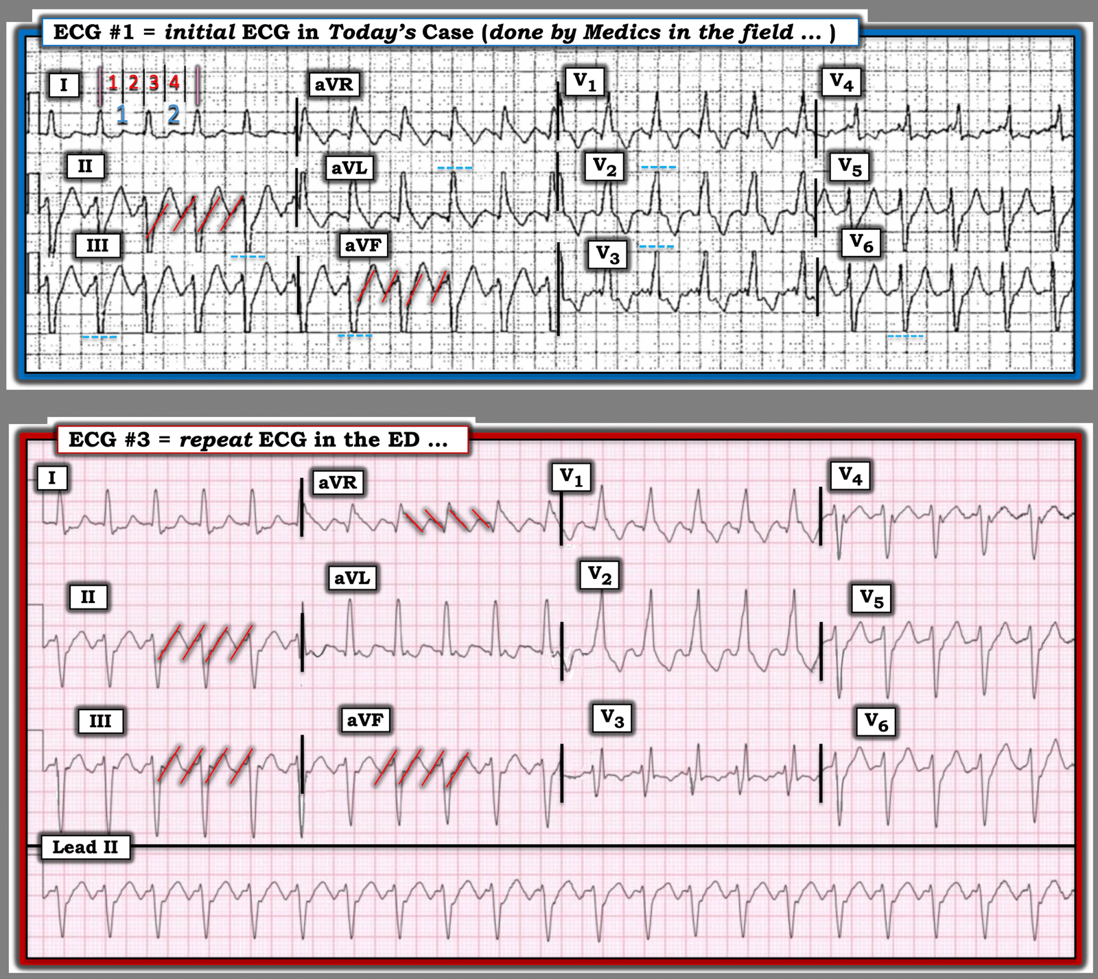 Wide complex Tachycardia in an 85 year old - Dr. Smith’s ECG Blog