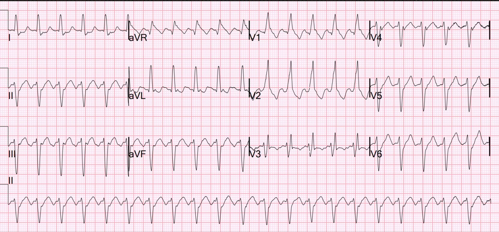 Wide complex Tachycardia in an 85 year old - Dr. Smith’s ECG Blog