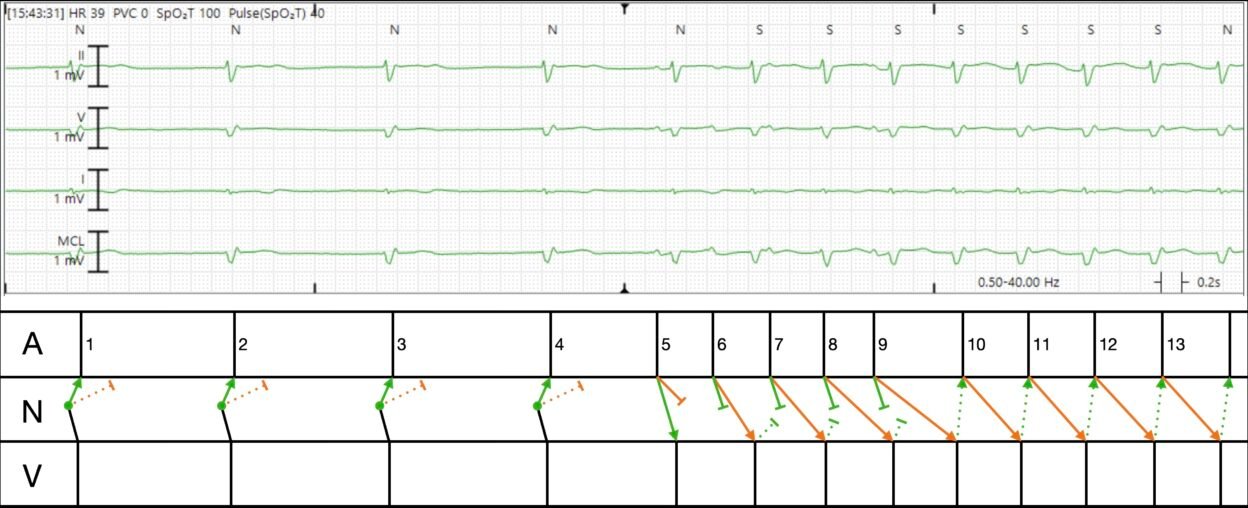 Narrow complex tachycardia, with interesting laddergram - Dr. Smith’s ...