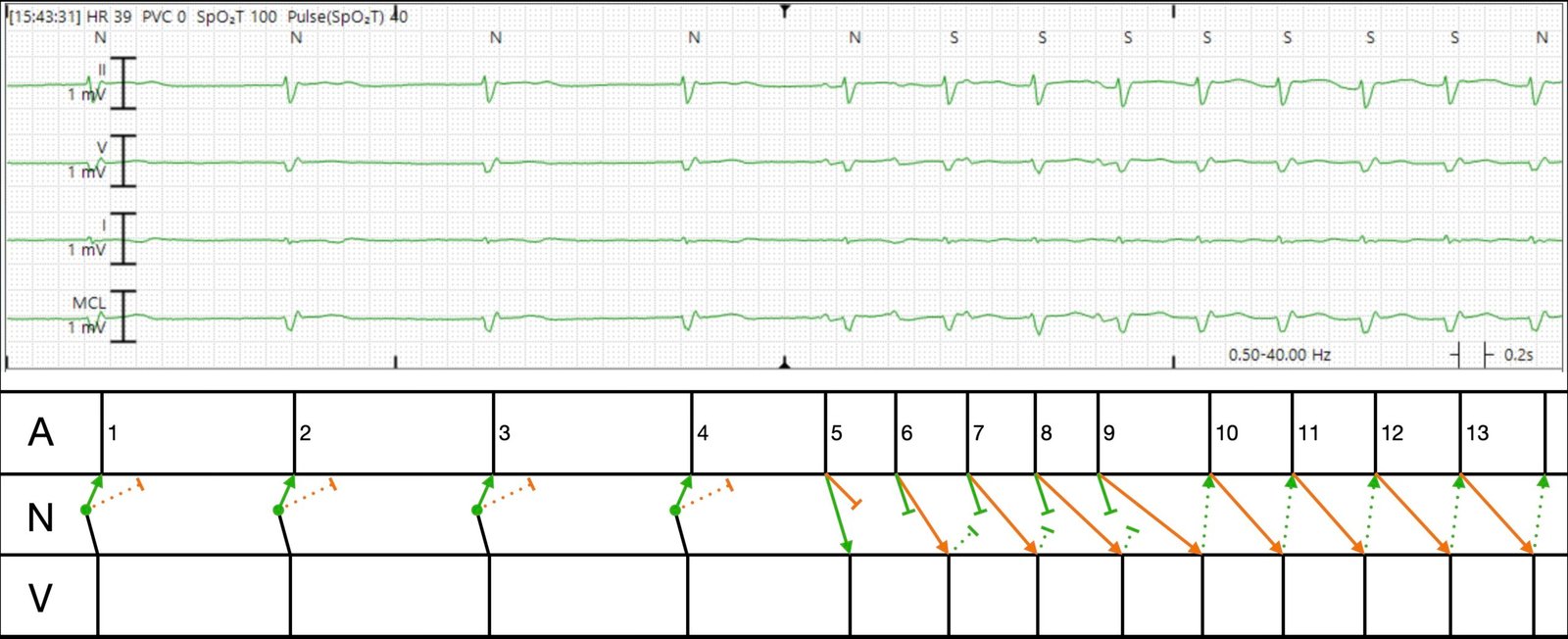 Narrow complex tachycardia, with interesting laddergram - Dr. Smith’s ...
