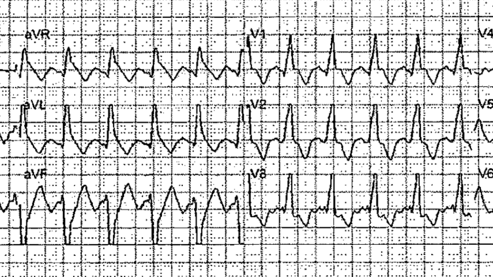 Steve Smith, Author at Dr. Smith’s ECG Blog