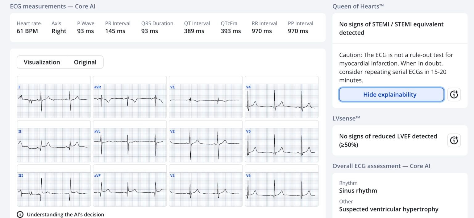 Worrisome chest pain and inferior ST Elevation - Dr. Smith’s ECG Blog