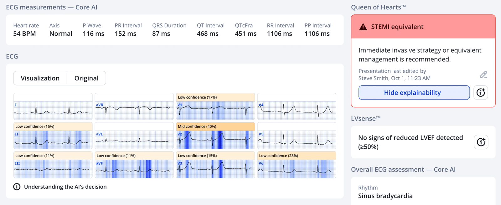 A 60 yo presented to the ED with chest pain, ECG findings missed, then ...