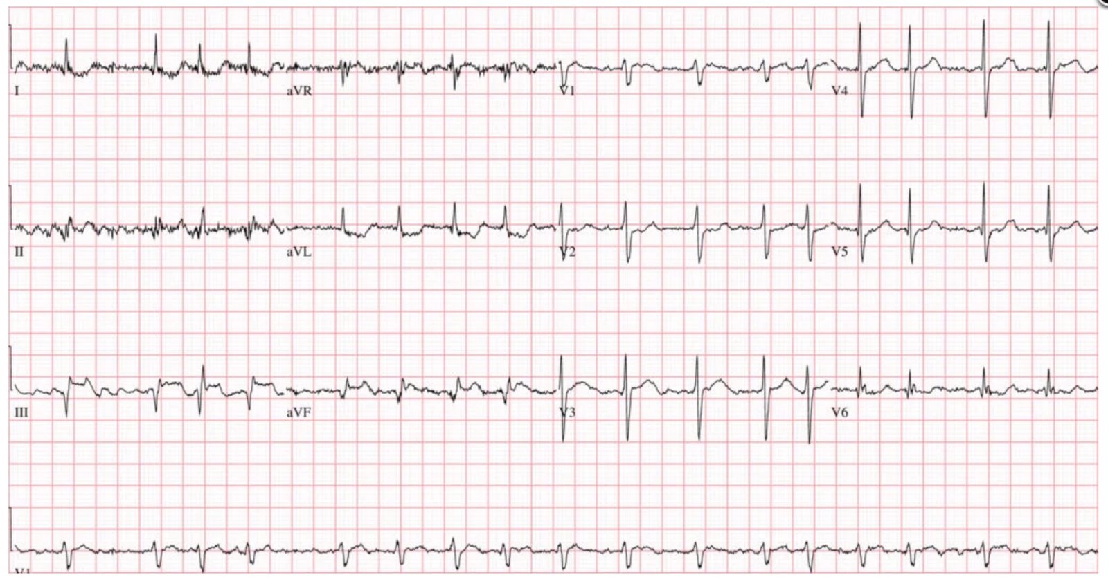 Sam Ghali video: A 55-year-old woman complaining of "severe indigestion ...