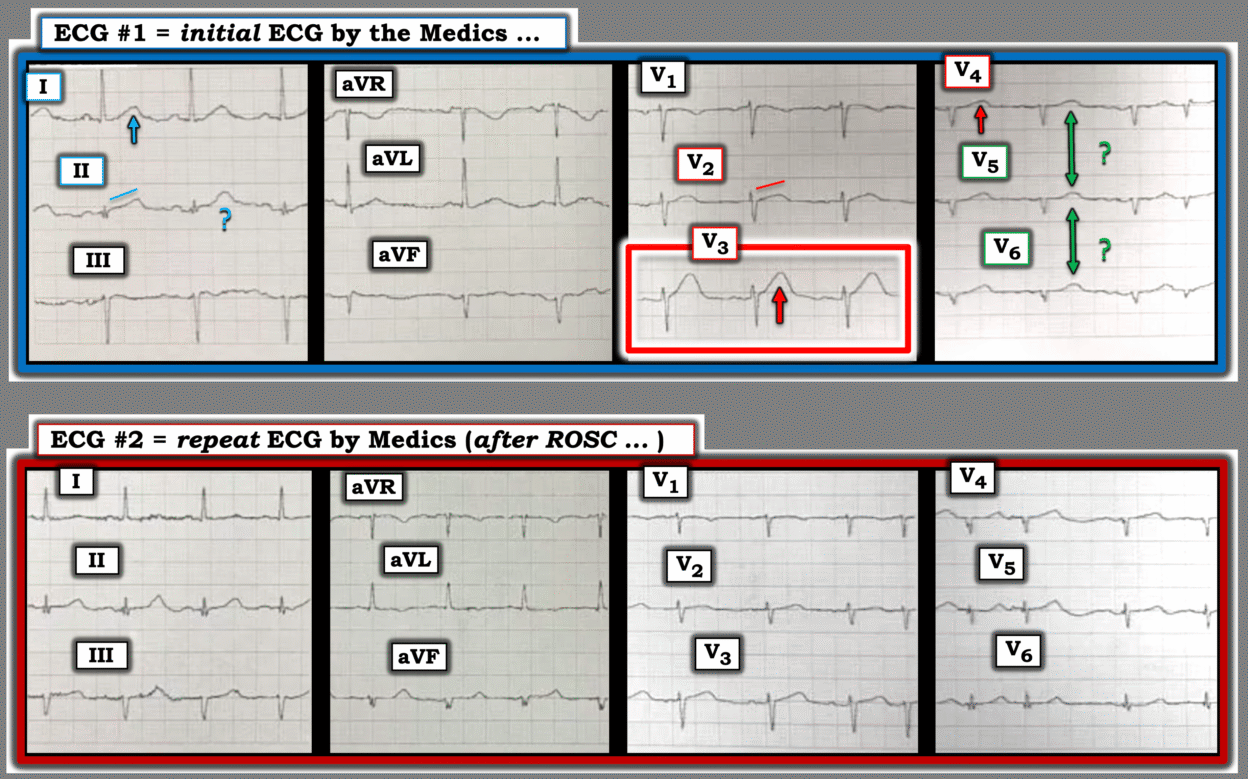 In chest pain, if the ECG is not diagnostic, can the medics safely ...