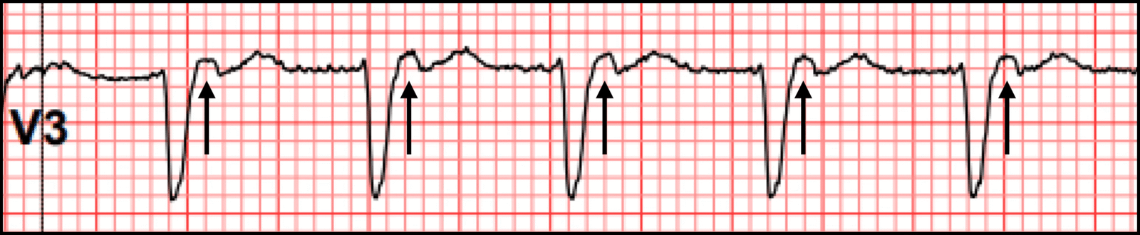 Narrow complex tachycardia, with interesting laddergram - Dr. Smith’s ...