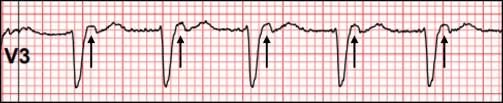 Narrow complex tachycardia, with interesting laddergram - Dr. Smith’s ...