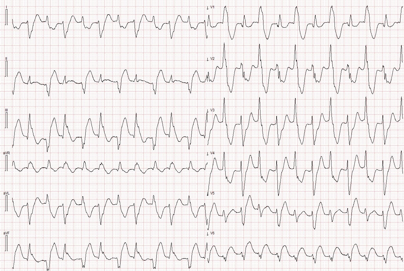 Fascinating Wide Complex Tachycardia and instructive ECGs during chest ...