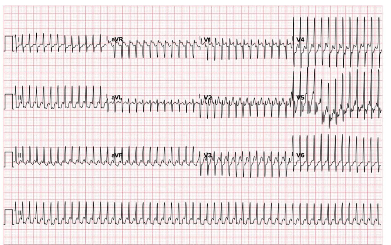 Extremely fast, narrow, regular - Dr. Smith’s ECG Blog