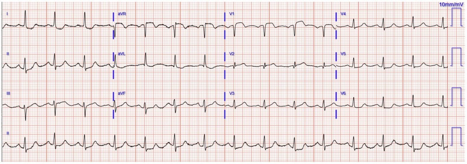 A woman in her 50s with chest pain. No diagnostic STE (that worthless ...