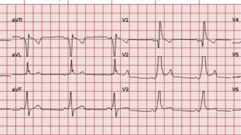 Atrial fibrillation with RVR and ST depression: POCUS, cardioversion ...