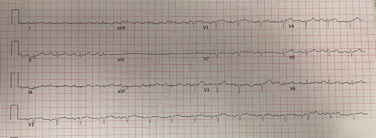 Should this patient get thrombolytics? When should PCI be performed ...