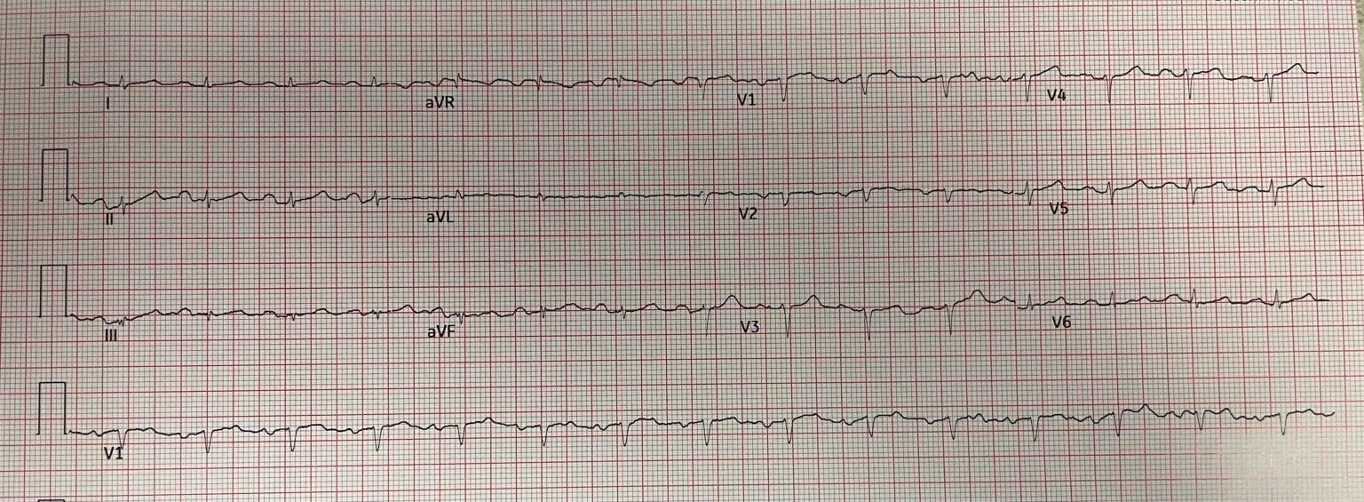 Should this patient get thrombolytics? When should PCI be performed ...