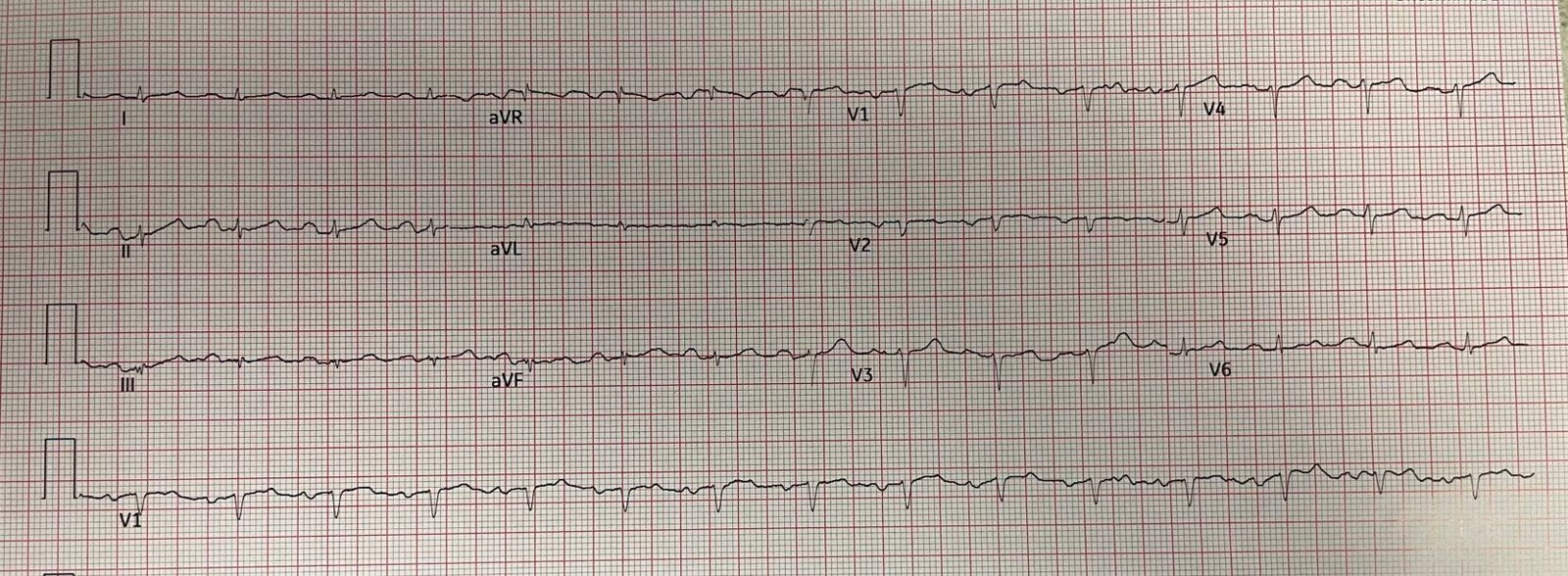 Should this patient get thrombolytics? When should PCI be performed ...