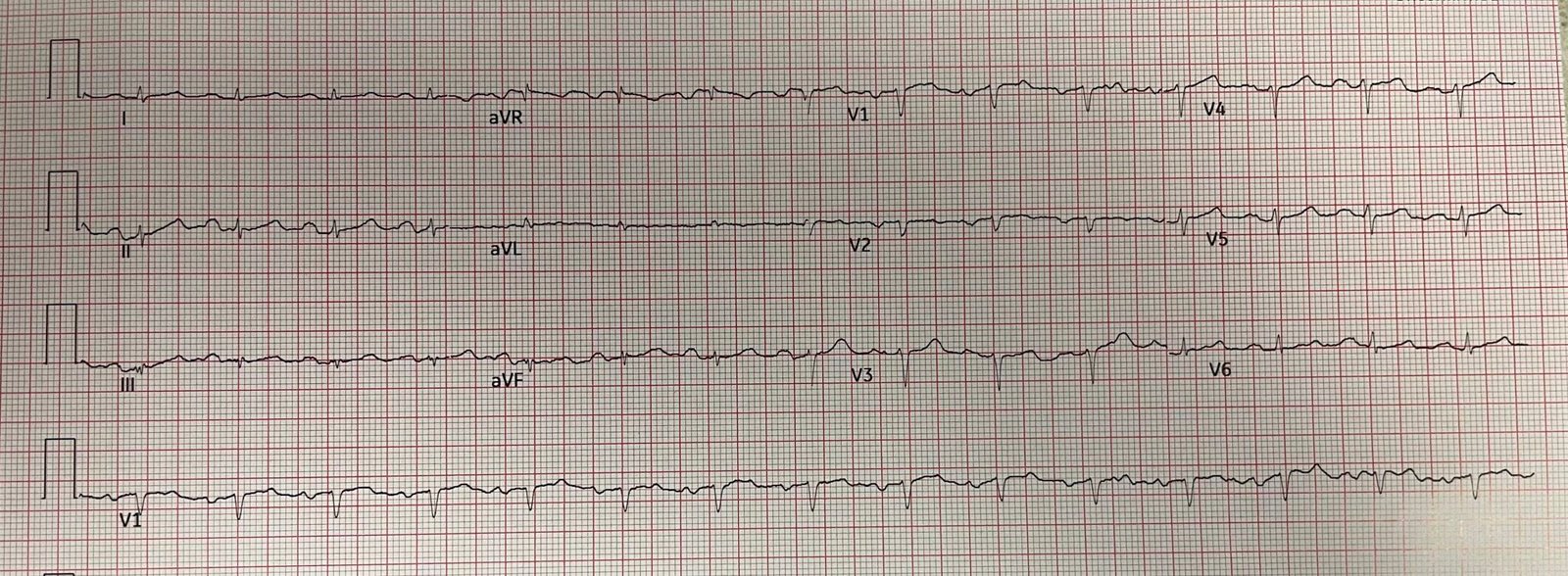 Should this patient get thrombolytics? When should PCI be performed ...