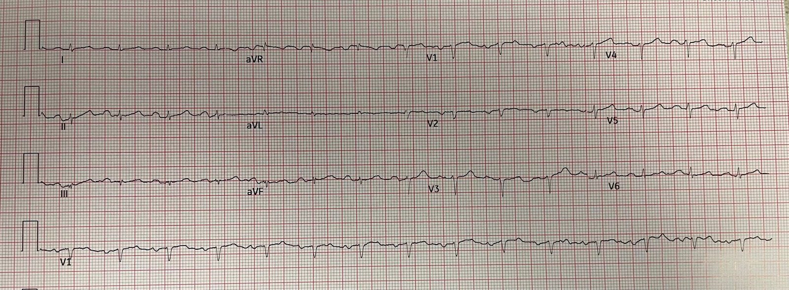 Should this patient get thrombolytics? When should PCI be performed ...