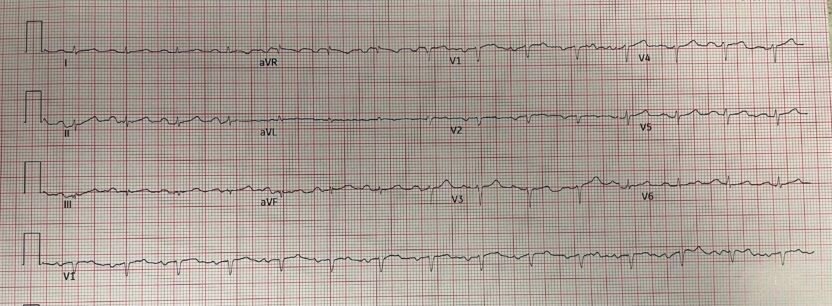 Should this patient get thrombolytics? When should PCI be performed ...
