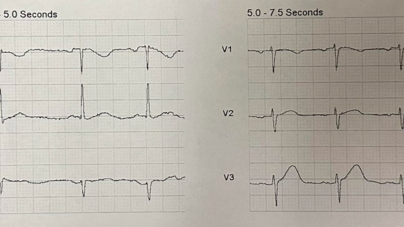 Steve Smith, Author at Dr. Smith’s ECG Blog