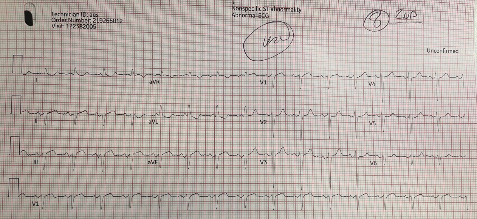 Atypical symptoms. Should we give thrombolytics? - Dr. Smith’s ECG Blog