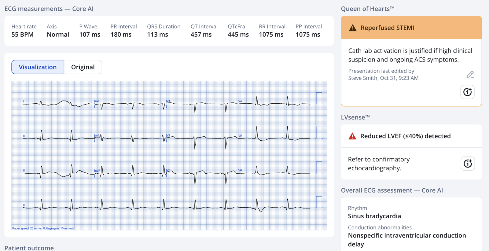 60 yo with Chest pain and cardiogenic shock, with acute LV failure ...
