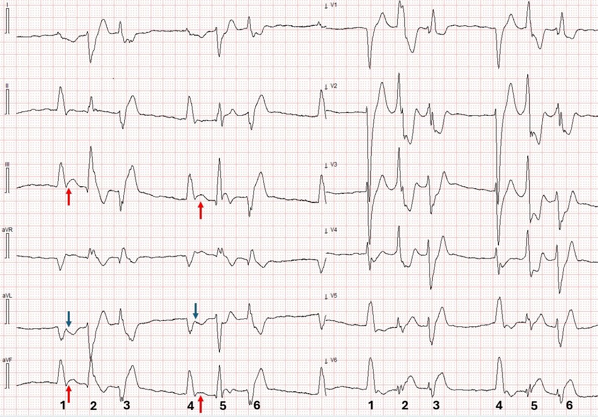 Fascinating Wide Complex Tachycardia and instructive ECGs during chest ...