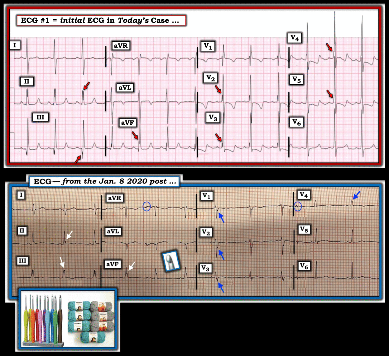 Dyspnea and chest pain. O2 saturation 88%. - Dr. Smith’s ECG Blog