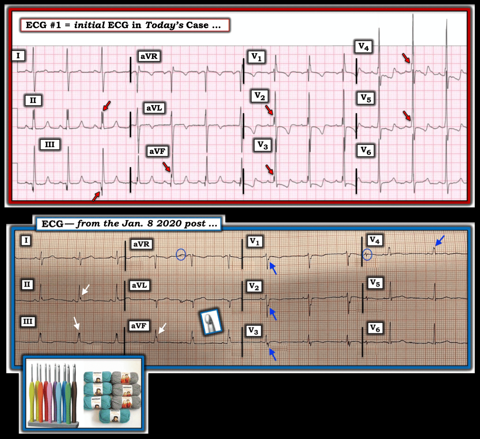 Dyspnea and chest pain. O2 saturation 88%. - Dr. Smith’s ECG Blog