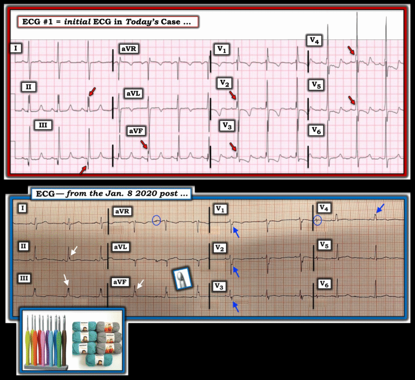 Dyspnea and chest pain. O2 saturation 88%. - Dr. Smith’s ECG Blog