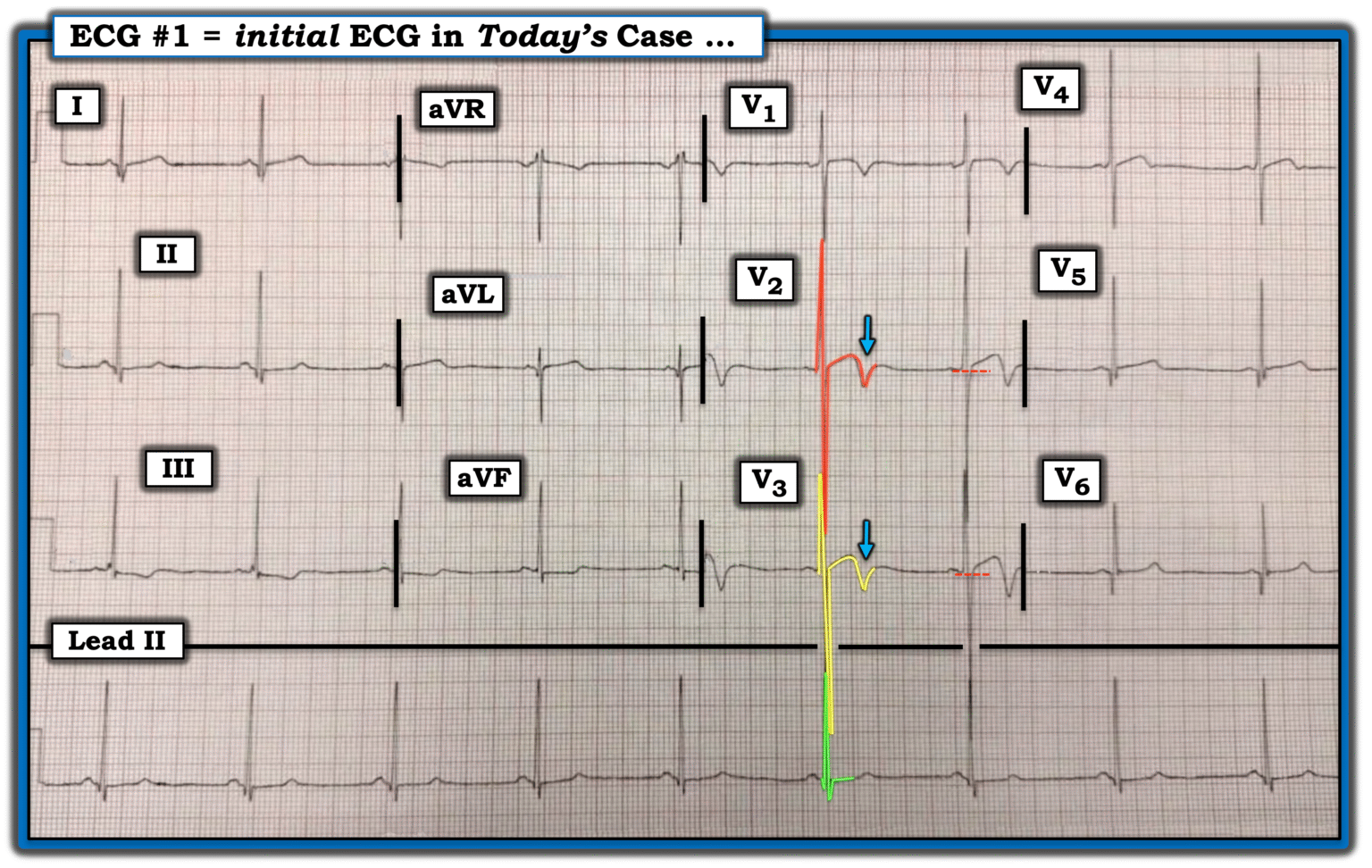 What is this pattern? - Dr. Smith’s ECG Blog