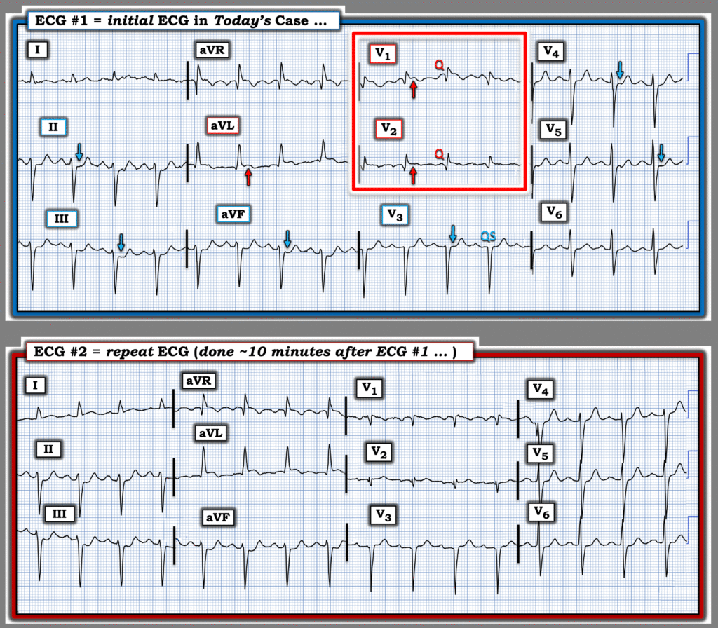 Chest pain, serial ECGs STEMI negative, first troponin normal: cancel ...