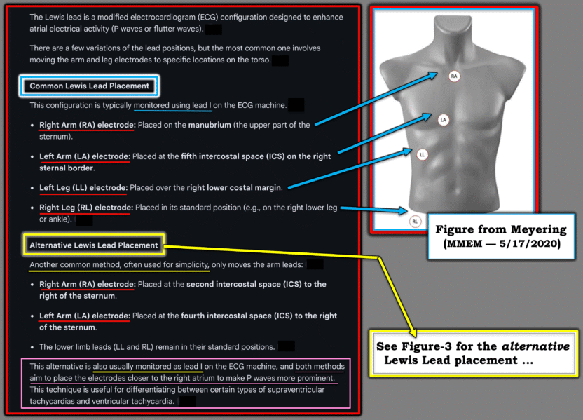 Atrial fibrillation with RVR and ST depression: POCUS, cardioversion ...