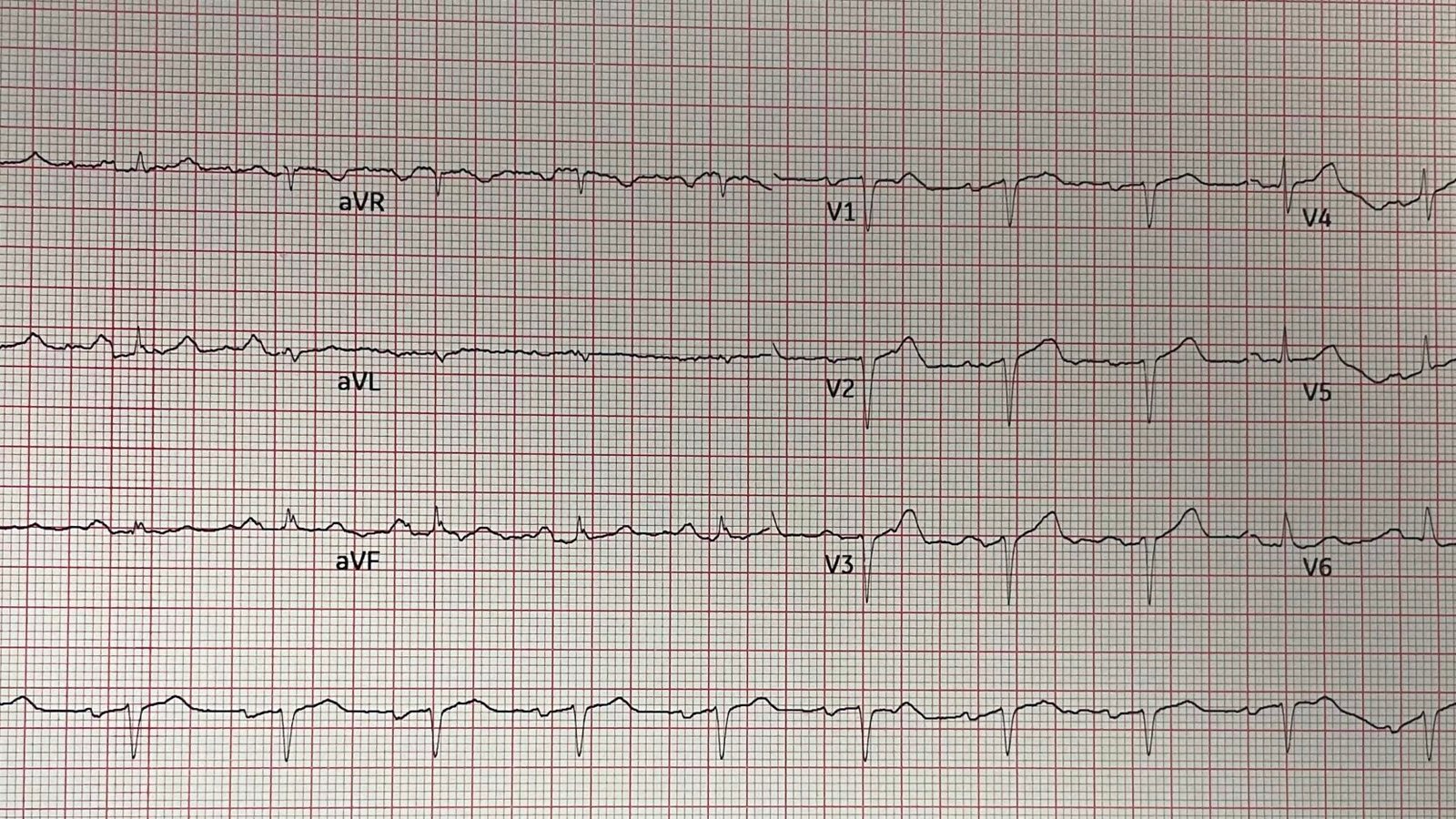 Dr. Smith’s ECG Blog - Page 2 of 198 - Expert ECG Interpretation and ...