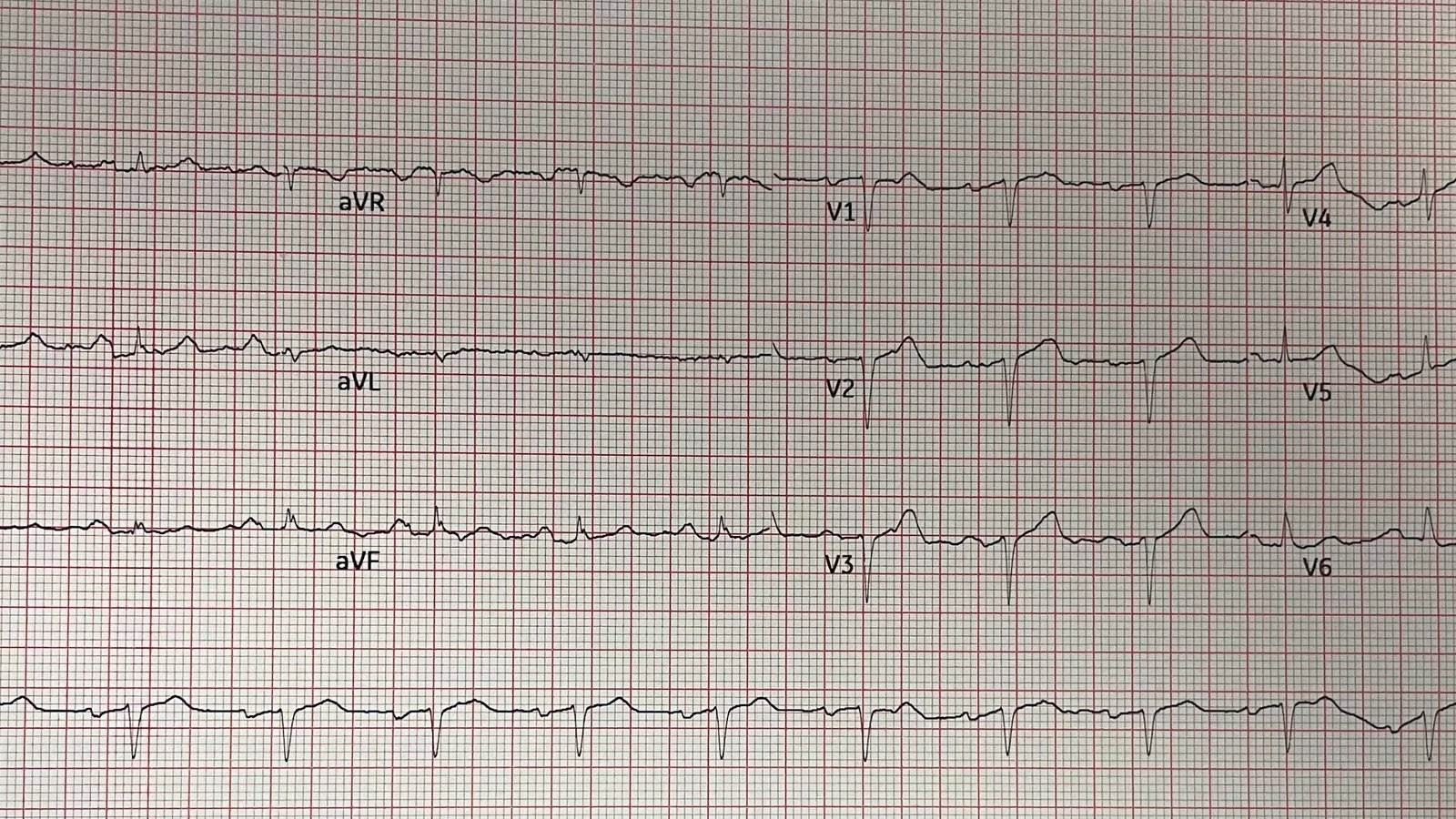 Queen knows Hyperacute T-waves Archives - Dr. Smith’s ECG Blog