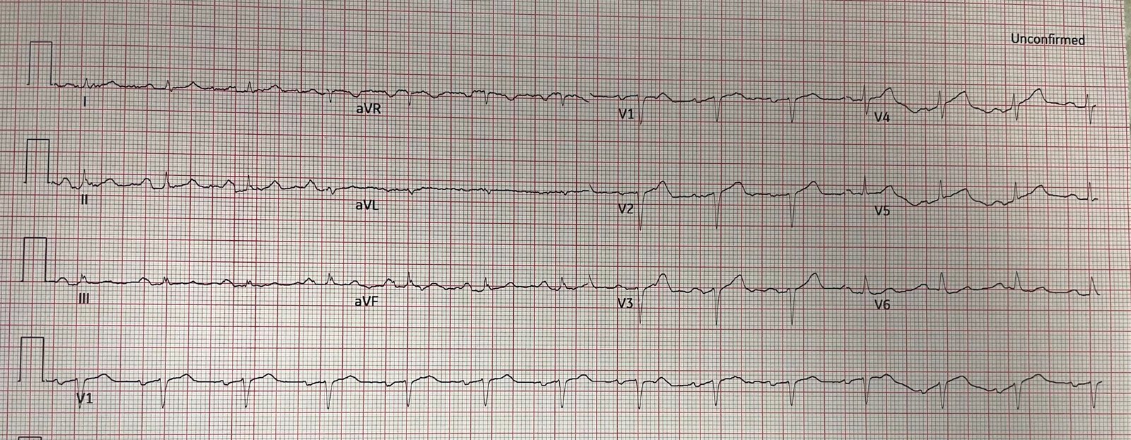 Should this patient get thrombolytics? When should PCI be performed ...