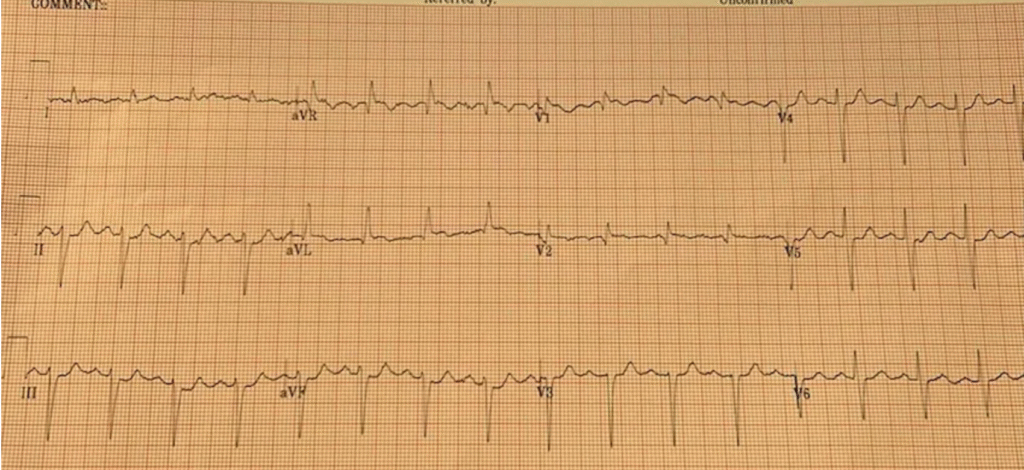 Chest pain, serial ECGs STEMI negative, first troponin normal: cancel ...