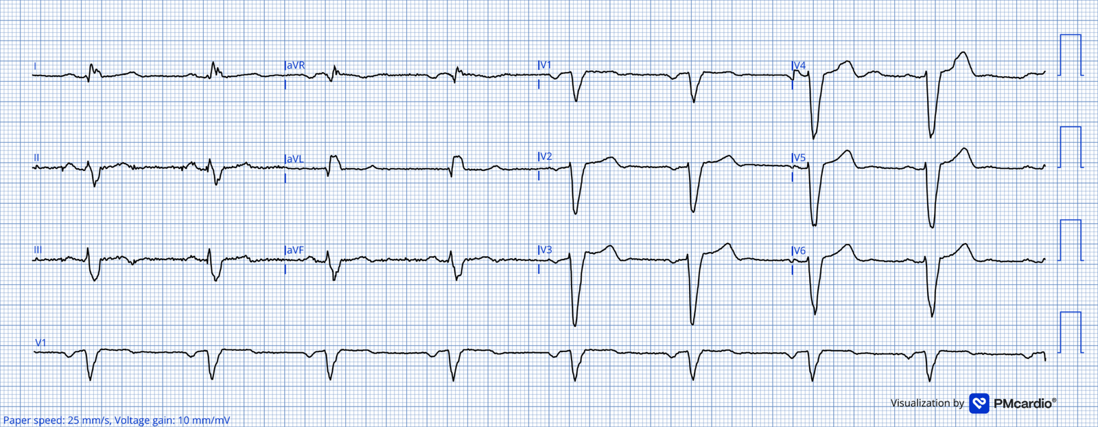 Dofetilde (and ibutilide -Class III antidysrhythmics). What is the risk ...