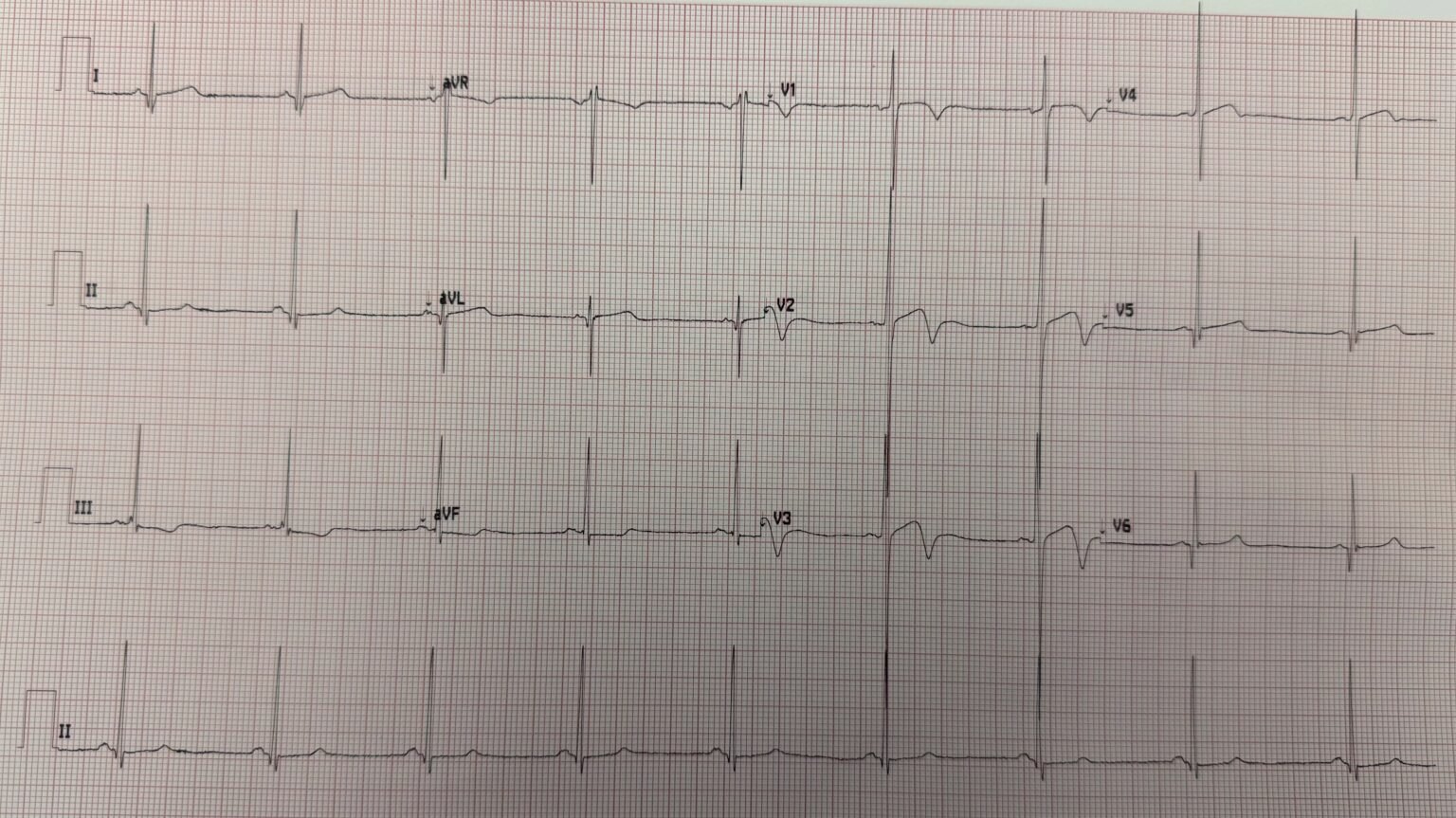 Atrial fibrillation with RVR and ST depression: POCUS, cardioversion ...
