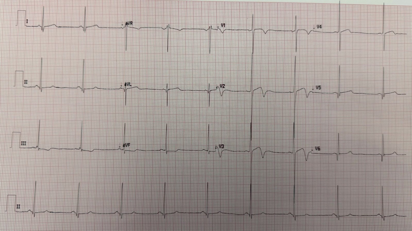 Steve Smith, Author at Dr. Smith’s ECG Blog