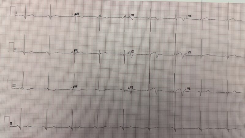 Steve Smith, Author at Dr. Smith’s ECG Blog