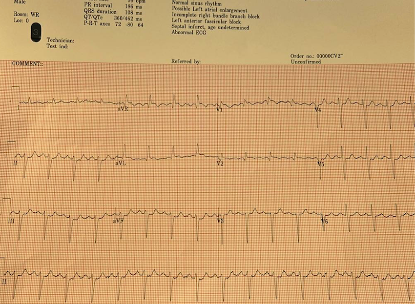 Chest pain, serial ECGs STEMI negative, first troponin normal: cancel ...