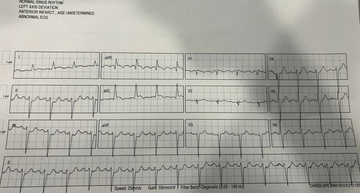 Chest pain, serial ECGs STEMI negative, first troponin normal: cancel ...