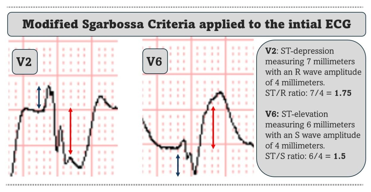 Fascinating Wide Complex Tachycardia and instructive ECGs during chest ...