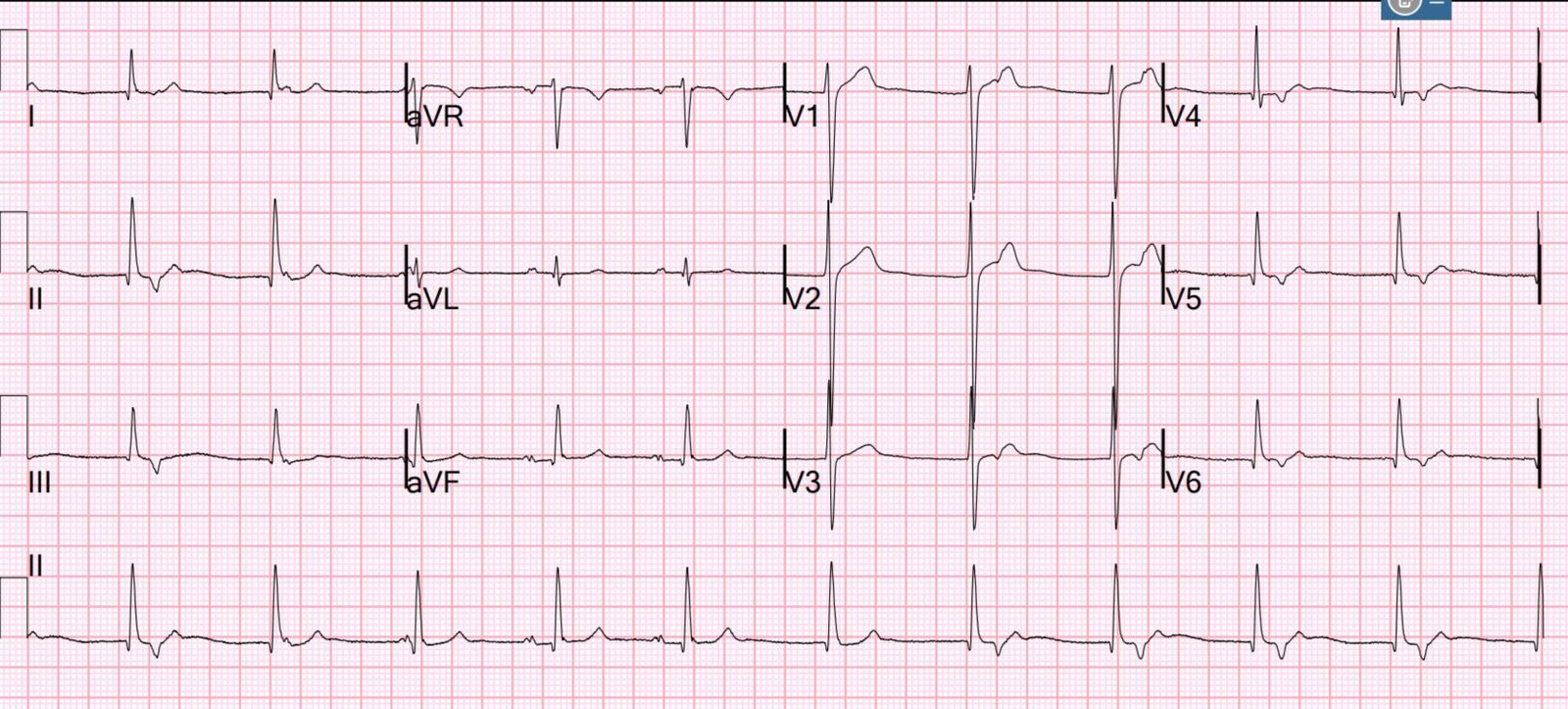 Syncope in a healthy person - Dr. Smith’s ECG Blog