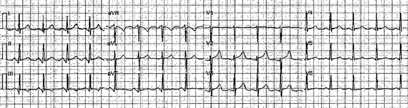 Acute chest pain in a 50-something: resolves, recurs, resolves: Does ...