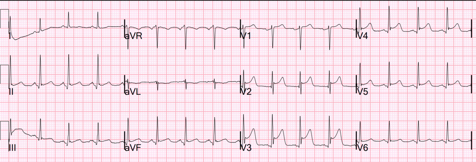 Acute chest pain in a 50-something: resolves, recurs, resolves: Does ...