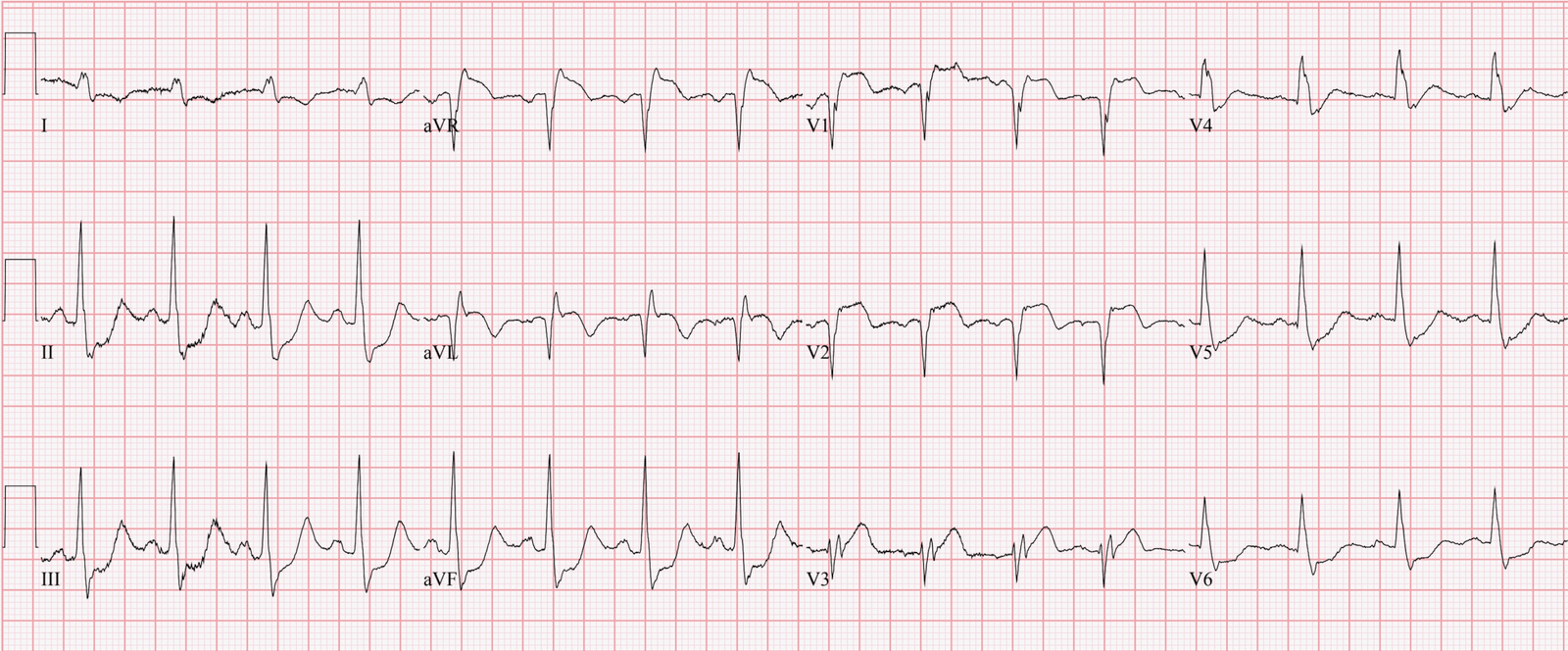How does Acute Total Left Main Coronary occlusion present on the ECG ...