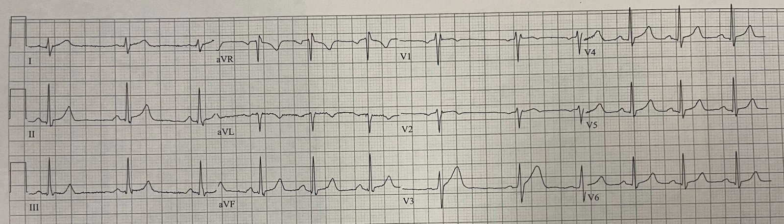 See Inflated Hyperacute T-waves deflate after thrombolytics - Dr. Smith ...