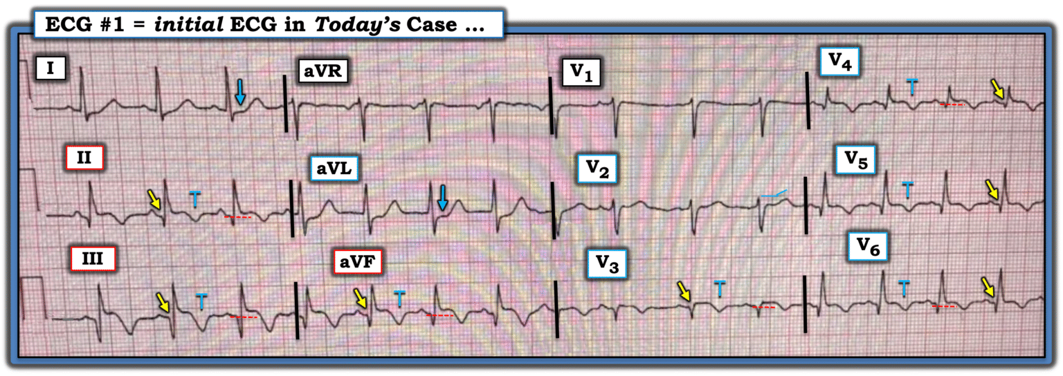 When should you get a CT scan on a STEMI patient to rule out aortic ...